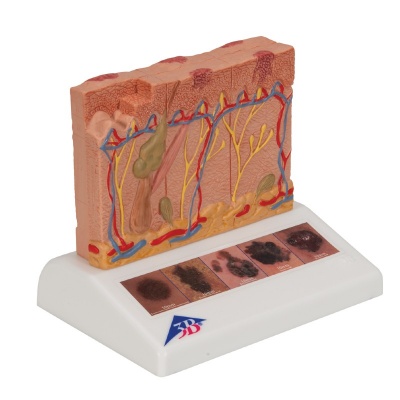 3B Scientific Magnified Skin Cancer Model | Health and Care